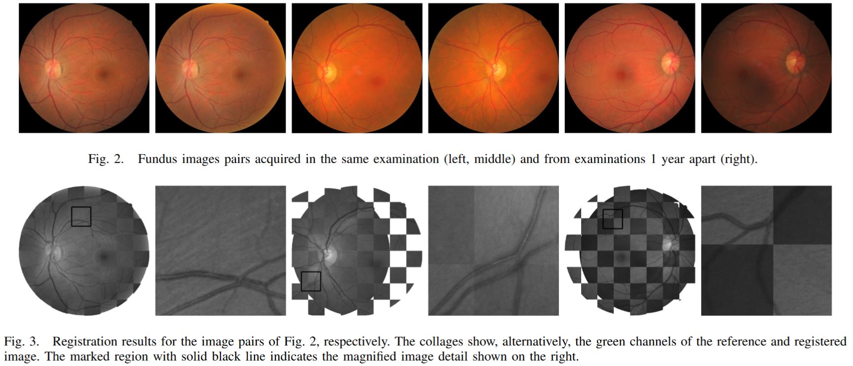 Retinal image registration based on keypoint correspondences, spherical ...