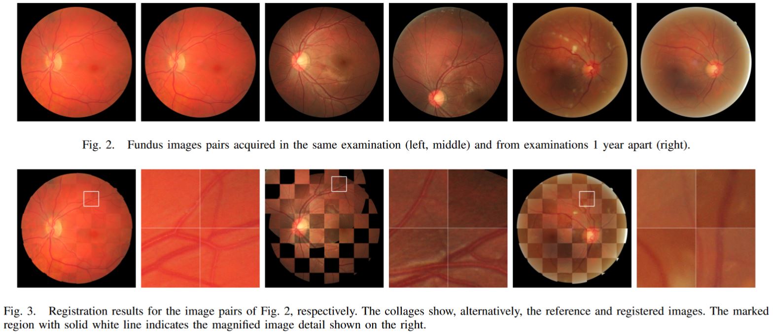 Retinal image registration through simultaneous camera pose and eye ...