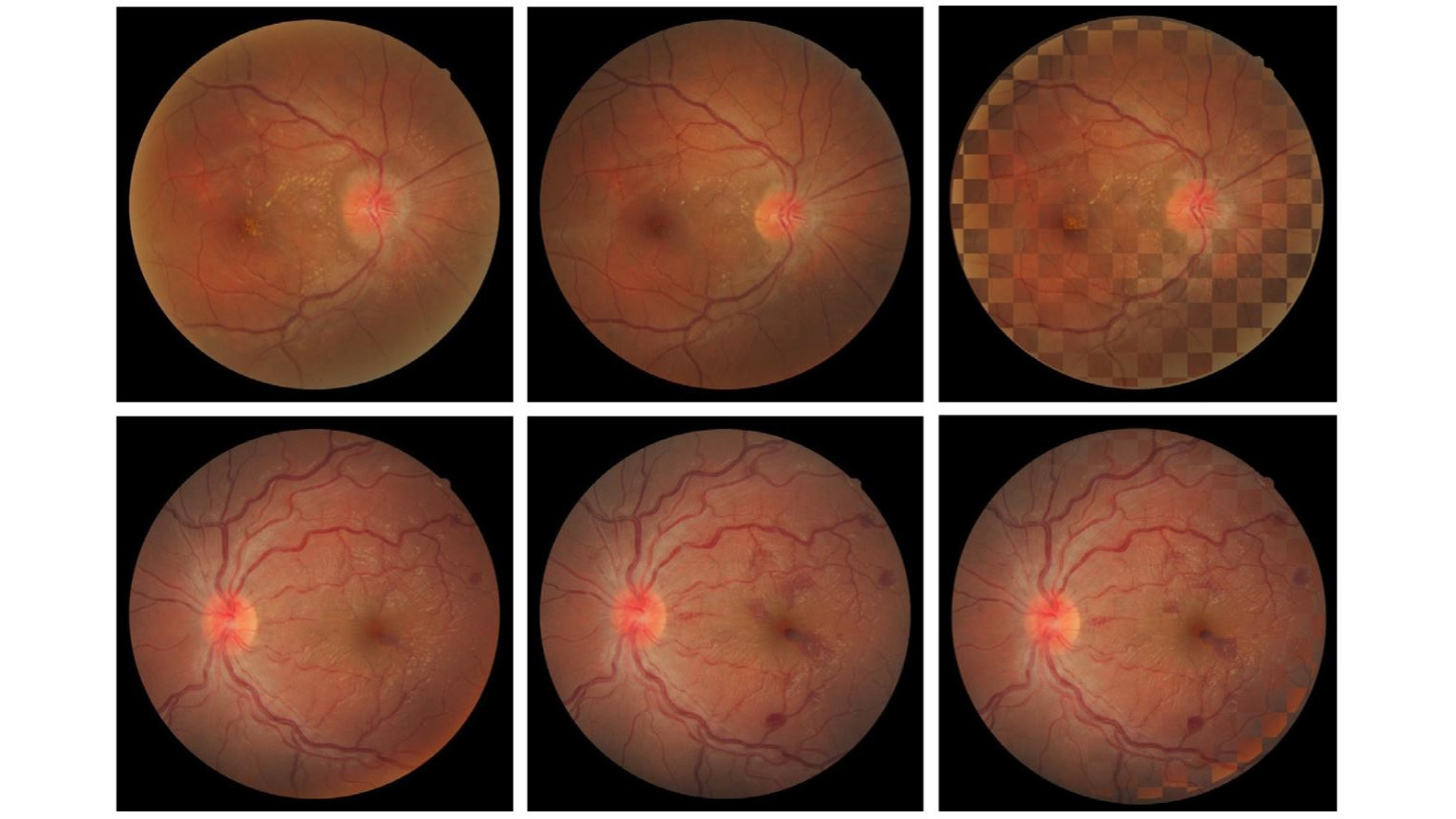 Retinal image preprocessing, enhancement, and registration | Carlos ...